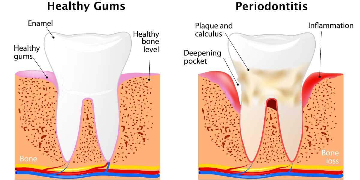 Stages Of Periodontal Disease